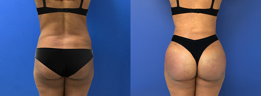 Brazilian Butt Lift Before and After by Dr. Tamer Shtayyeh - Page #1 | Icon Cosmetic Center