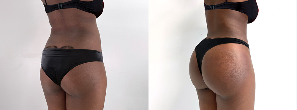 Brazilian Butt Lift Before and After by Dr. Tamer Shtayyeh - Page #1 | Icon Cosmetic Center